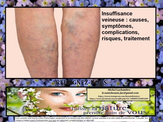 Insuffisance veineuse : causes, symptômes, complications, risques ...
